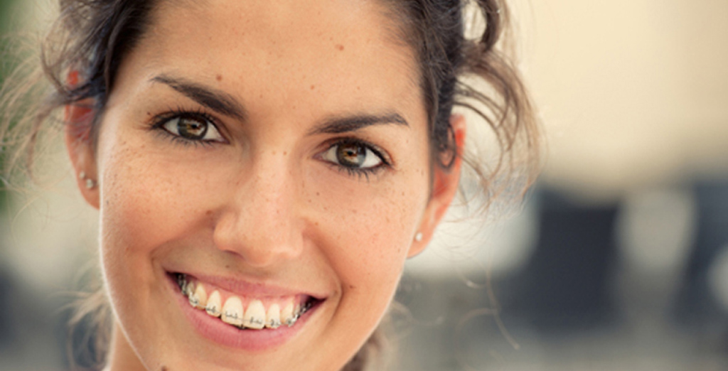 Brackets para adultos, ventajas y tipos.