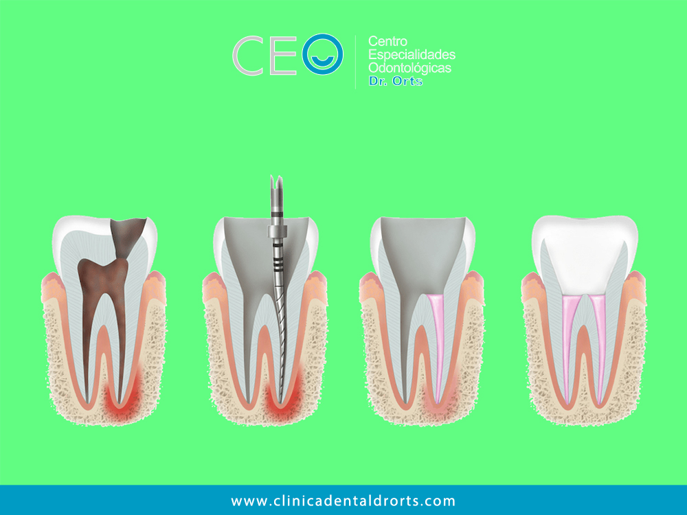 La Endodoncia