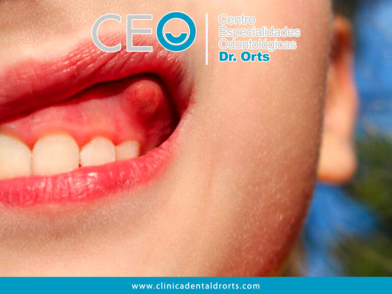 El Quiste Dental
