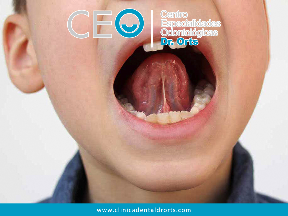 Cirugía de Frenillo