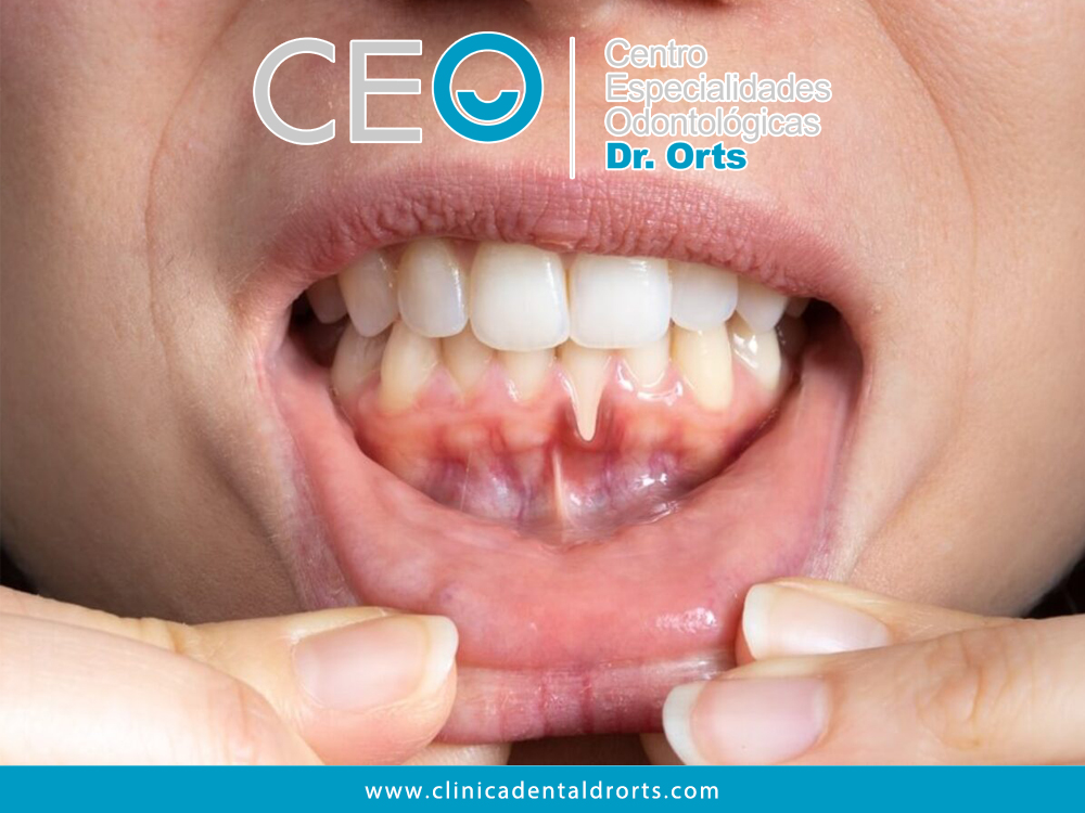 Retraimiento de Encías