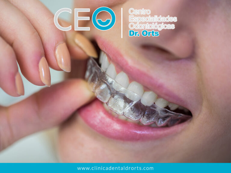 Retenedores Dentales: Tipos y Cuándo Usarlos